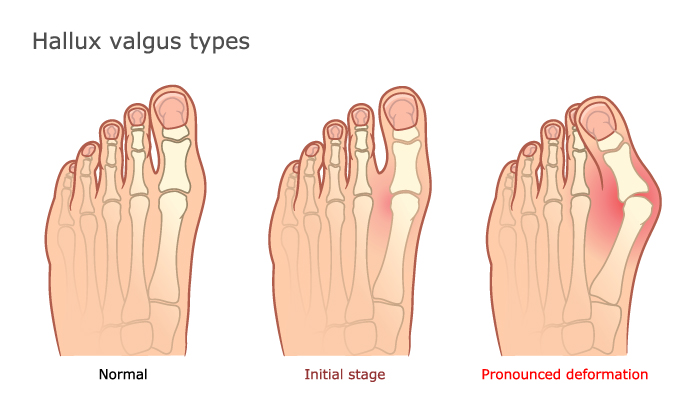 Hallux Valgus Bunion Dr Mohamed Attia M D PhD Hallux Valgus Bunion Dr Mohamed Attia M D PhD