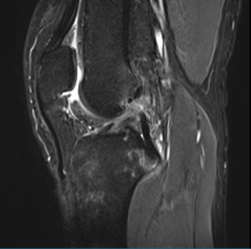 Arthroscopic Anterior Cruciate Ligament Reconstruction - Dr. Mohamed ...