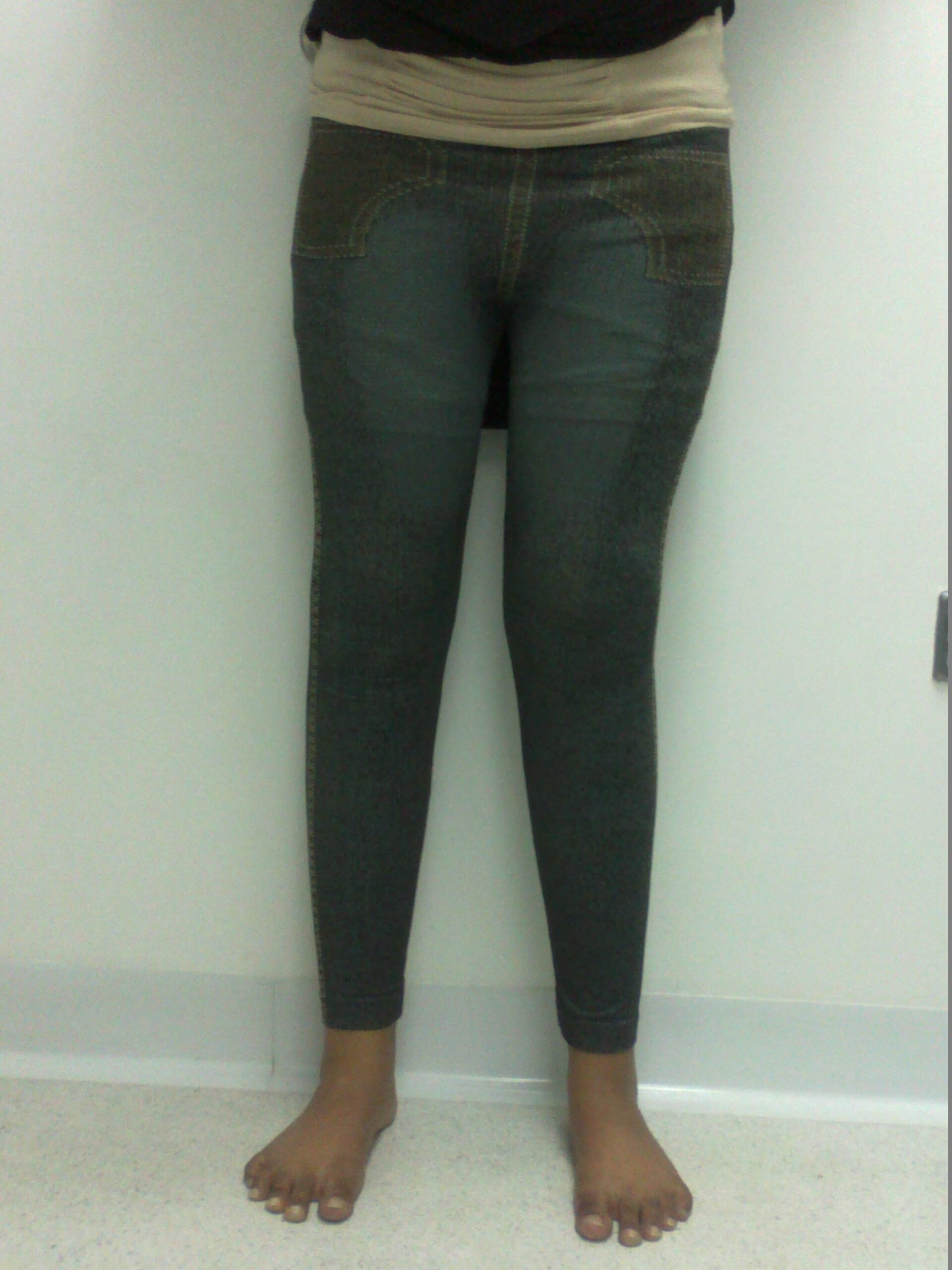 Limb Lengthening And Reconstruction - Dr. Mohamed Attia, M.D. PhD