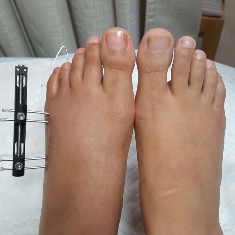 Limb Lengthening And Reconstruction - Dr. Mohamed Attia, M.D. PhD