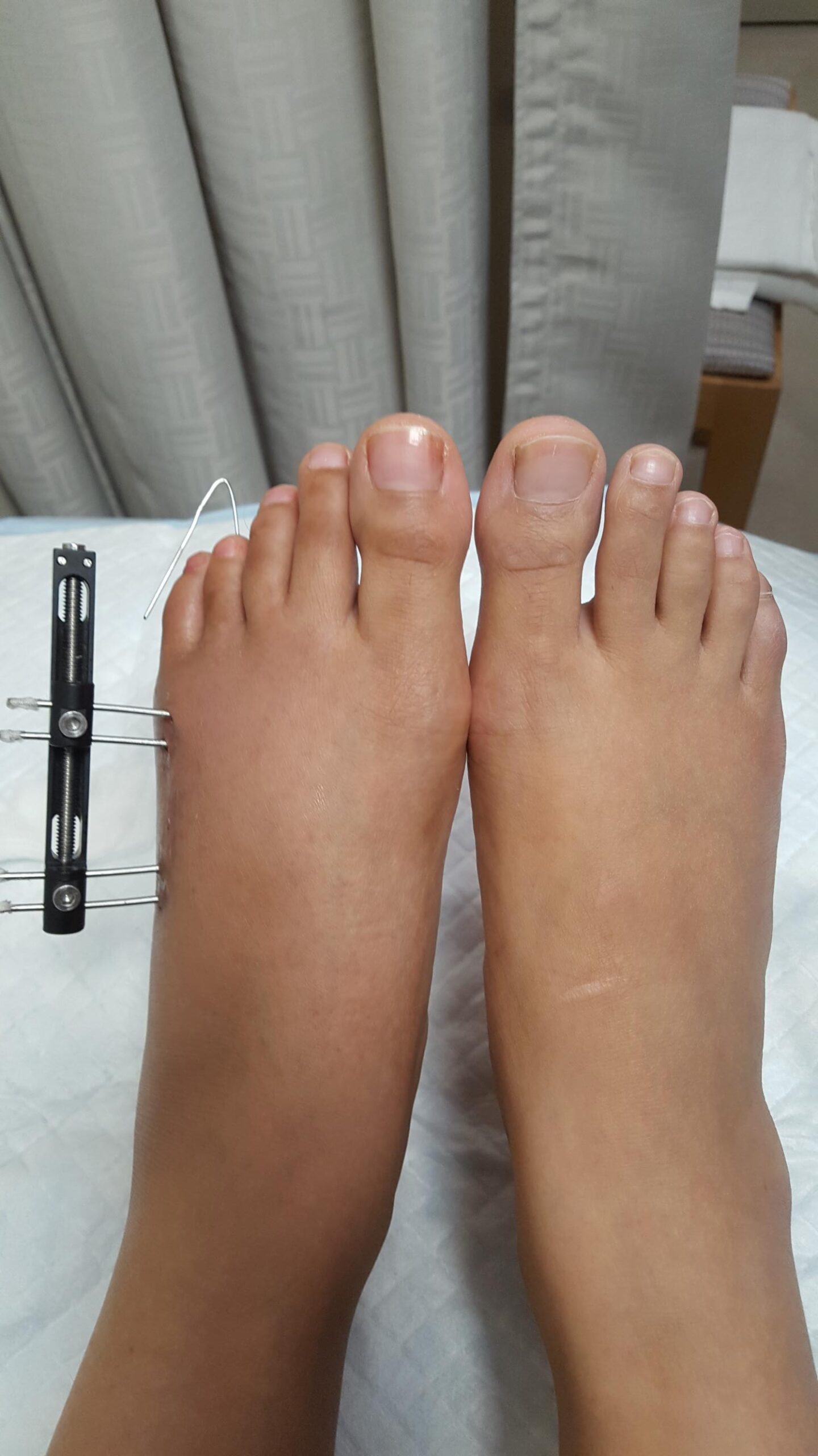 Limb Lengthening And Reconstruction - Dr. Mohamed Attia, M.D. PhD